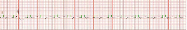 EKG Rhythm Strip Quiz 32