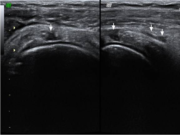 HIGH RESOLUTION SONOGRAPHY IN ROTATOR CUFF TEAR - Sumer's Radiology Blog