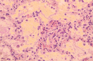 Fases de la Neumonía