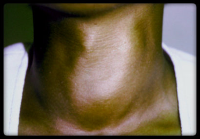 Cancer de tireoide sintomas e tratamento. - Artigos sobre saúde