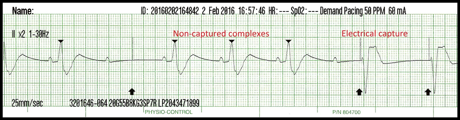 ACLS review: Bradycardia part 4