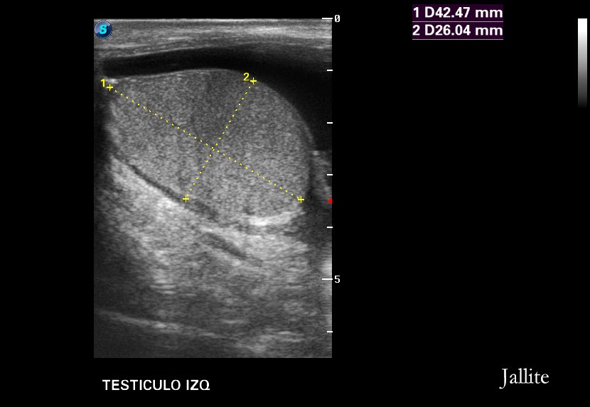 Hidrocele Bilateral y....