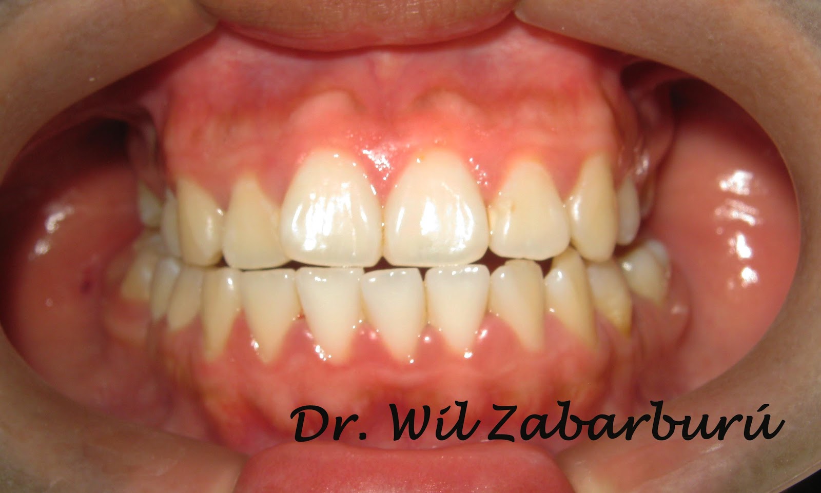 CLINICA DENTAL ASISTENCIAL: DIENTES SUPLEMENTARIOS, INCISIVO LATERAL