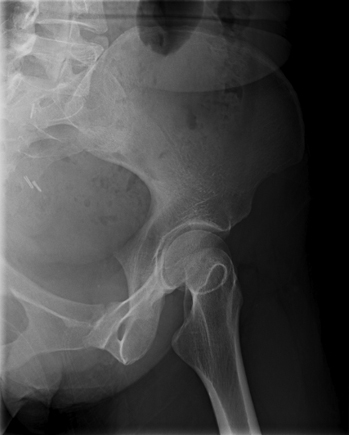 Tecnicos Radiologos: Protusión acetabular en trauma de pelvis ...