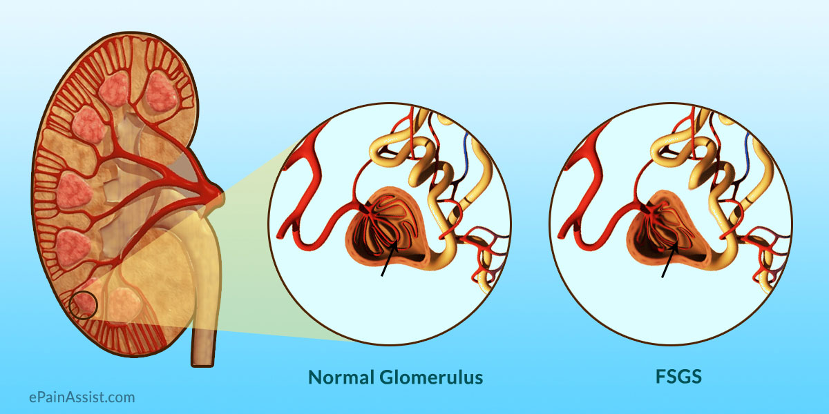 Renal-disease: Renal failure in FSGS patients and its treatment