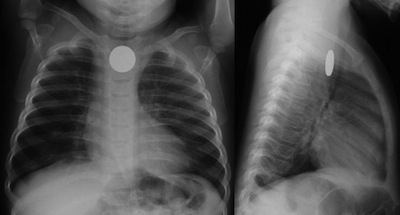 100 ICU-Anesthesia : Coin ..In Esophagus or in trachea