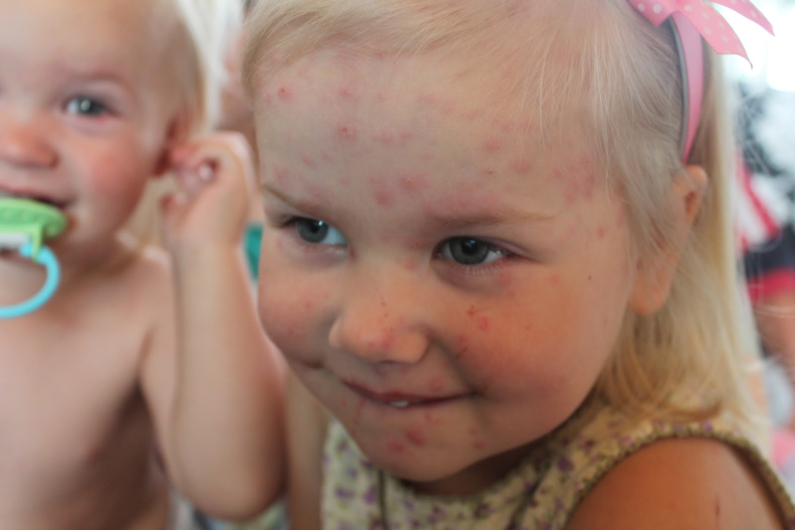 Suurperheellistä elämää: Vesirokko