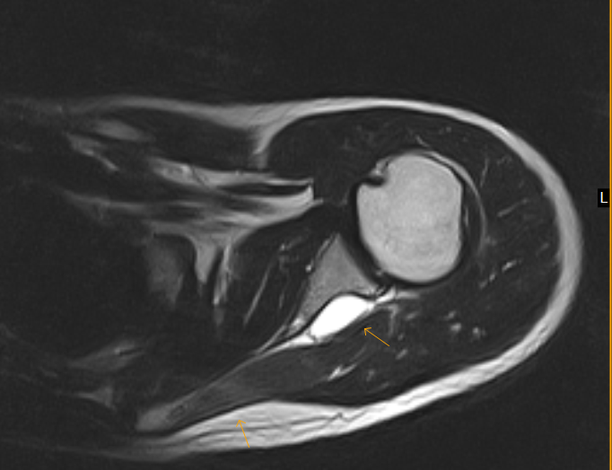 Spinoglenoid Ganglion Cyst with isolated Infraspinatus Atrophy - Sumer ...