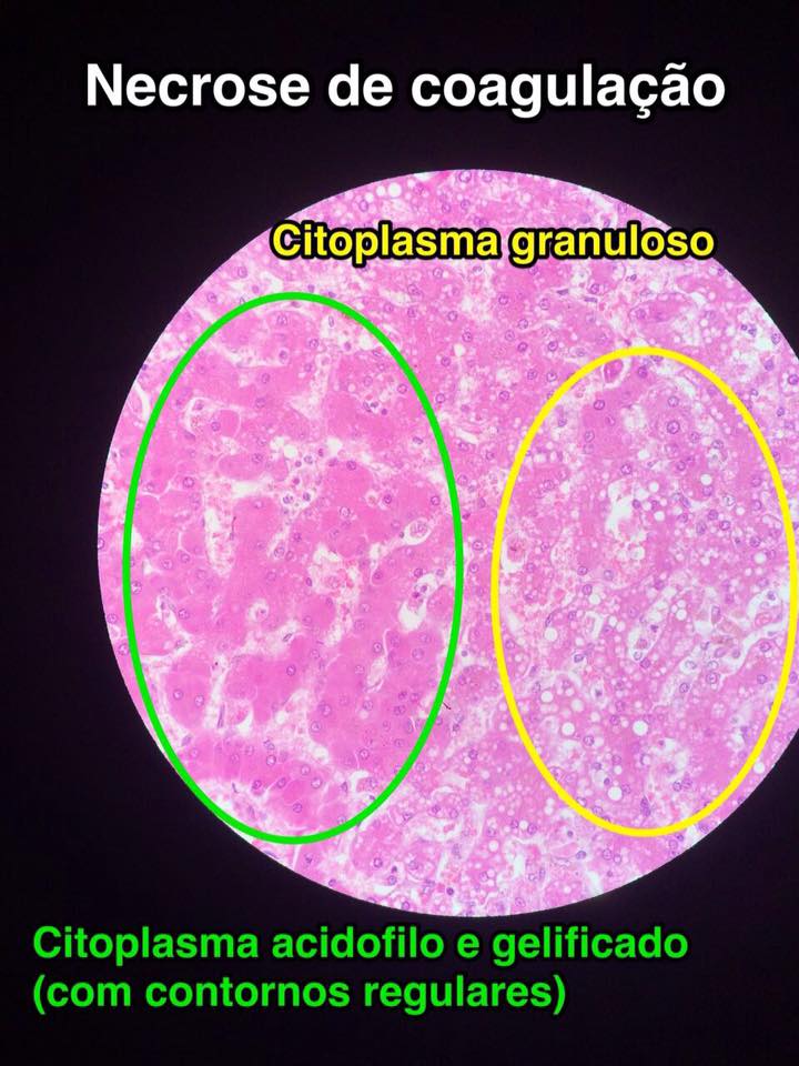 HISTOLOGIA90: TIPOS DE NECROSE