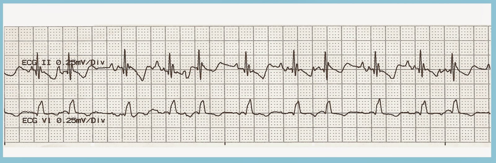 Practice EKG Strips 420