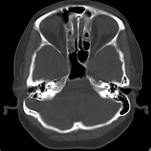 Neuroradiology Cases: Deep sigmoid sulcus