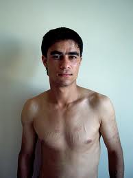 Self Injury and the Body: Levels of Self Injury Through Photos