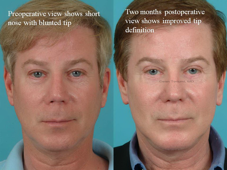 Dr. Dean Toriumi Reviews: Dean Toriumi Reviews: Severely scarred nose ...