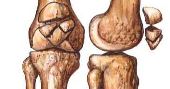 Fractura de la rótula - Botiquin de primeros auxilios PRO!!