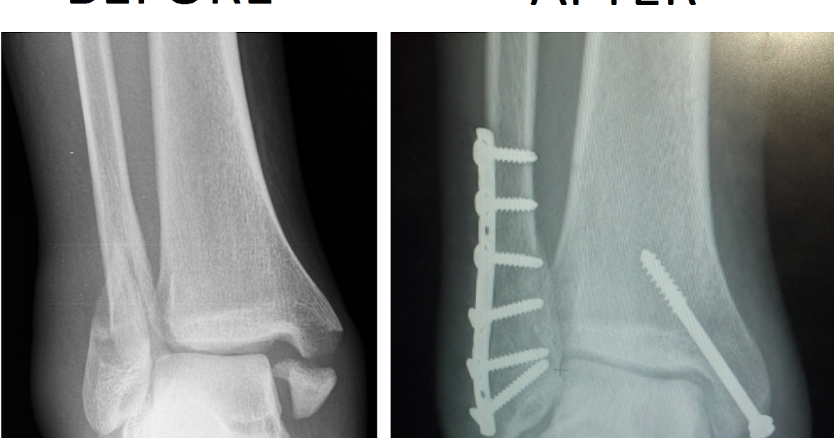 Ankle Fracture - Causes | Symptoms | Treatment