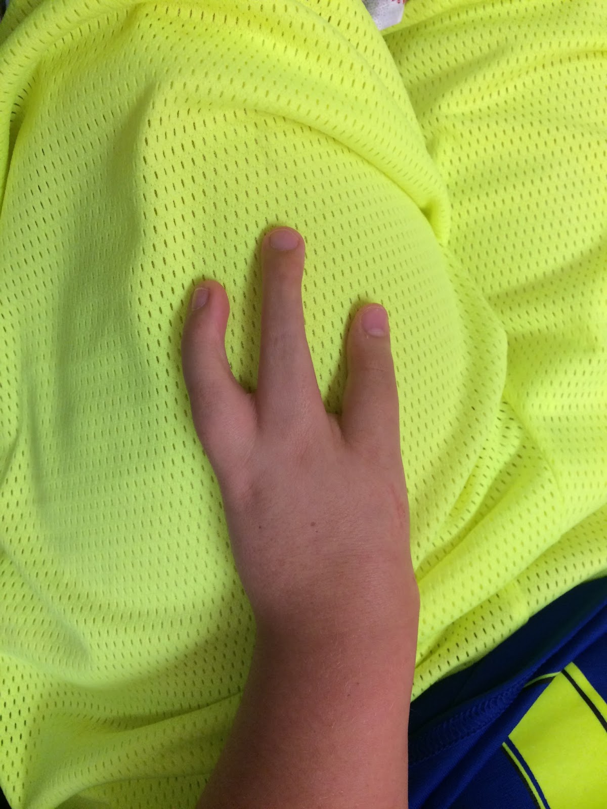 Thumb position and the 3 digit hand | Congenital Hand and Arm ...