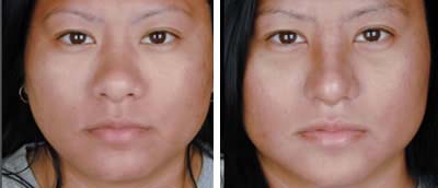 Alar Base Reduction - Reduce nose wings