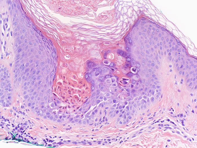 VIRTUAL GRAND ROUNDS IN DERMATOLOGY 2.0: Keratosis Follicularis