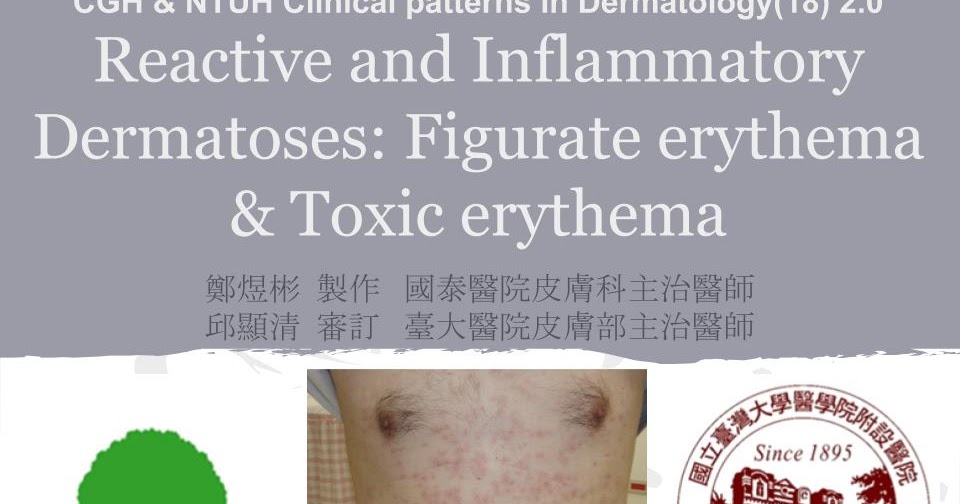 國泰皮膚科/台大皮膚部Reactive and Inflammatory Dermatoses: Figurate erythema ...
