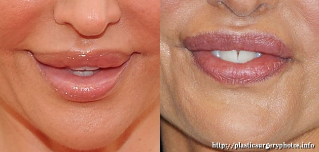 Lisa Rinna Plastic Surgery Before and After Botox and Breast ...