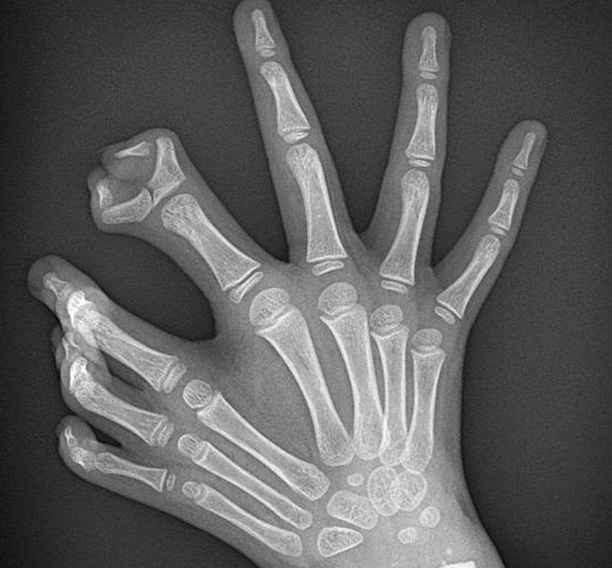 Diarios de Radiologia: Síndrome de la mano en espejo