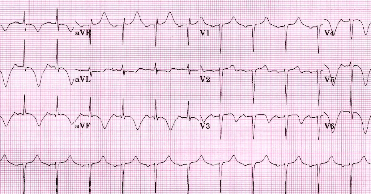 Study Medical Photos: Cerebral 'T waves' on ECG
