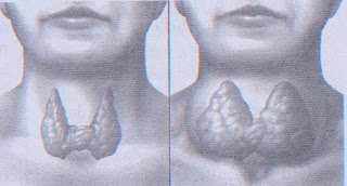 kenali Penyakit Tiroid sejak dini: TENTANG PENYAKIT TIROID ( GONDOK )