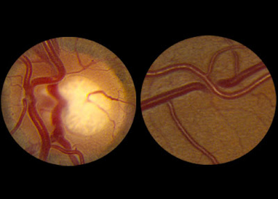 FUNdus exams: A/V nicking and other hypertensive vascular changes.