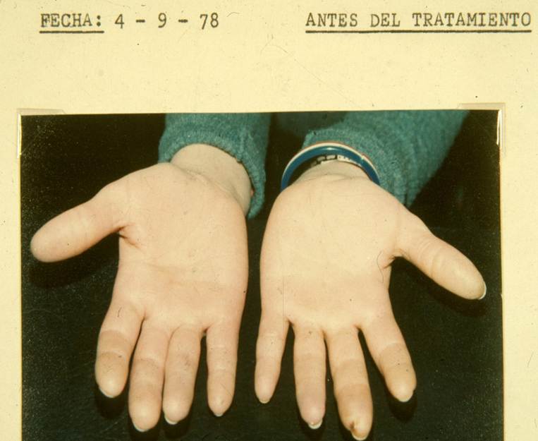 HOMEOPATÍA FICH: ACROCIANOSIS O SINDROME DE RAYNAUD CON GANGRENA DR ...