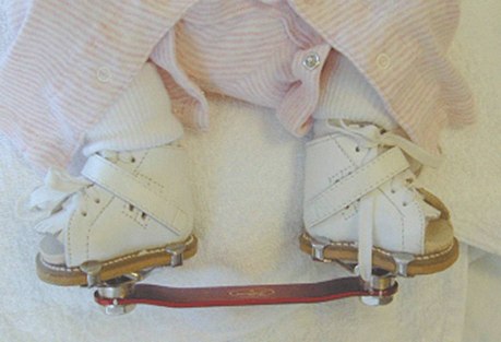 RSOP Melayani Pengobatan Kaki Pengkor atau CTEV (Congenital Talipes ...