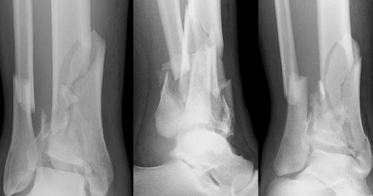 The Comprehensive Guide To Tibial Plafond Fracture Treatment