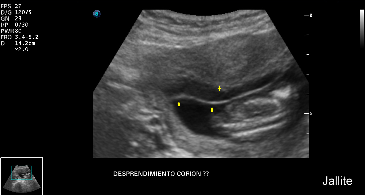 Hematoma Retrocorionico & Placenta Marginal