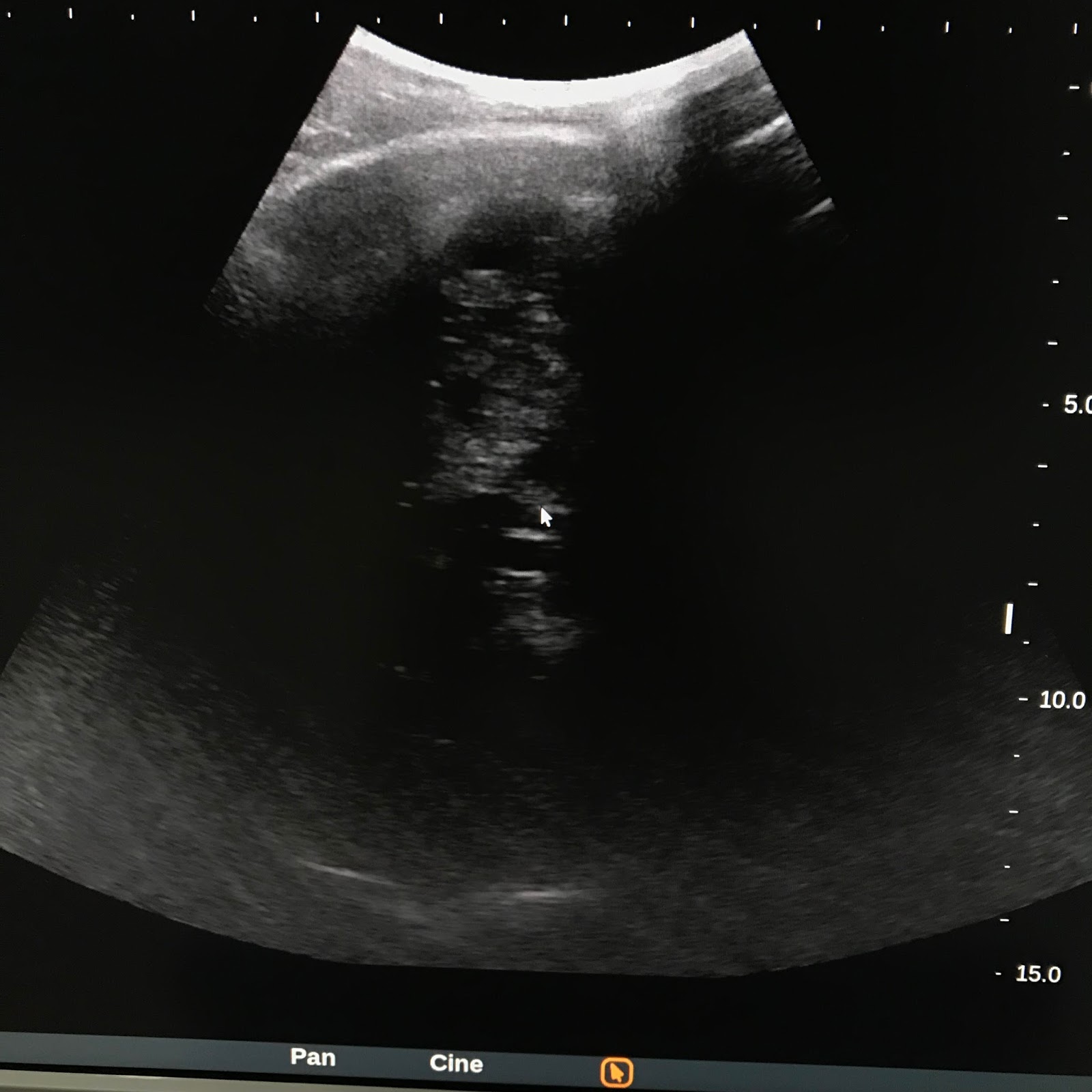 VIETNAMESE MEDIC ULTRASOUND: CASE 487: BRAIN AVM, Dr PHAN THANH HẢI ...