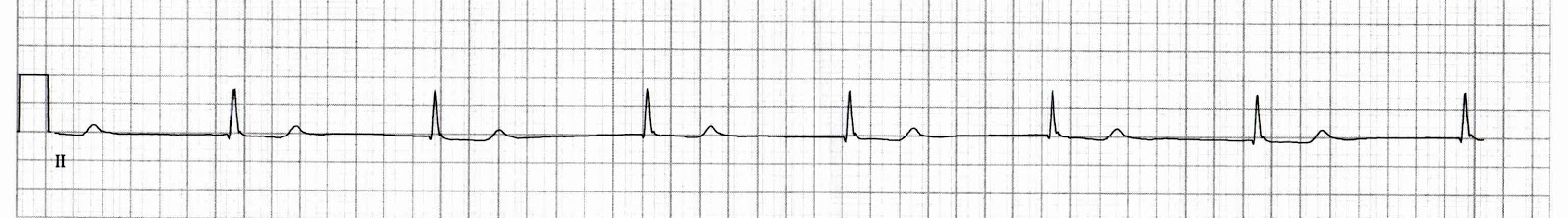 ECG Channel: Junctional Rhythm