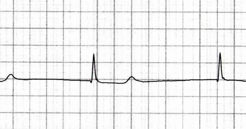 ECG Channel: Junctional Rhythm