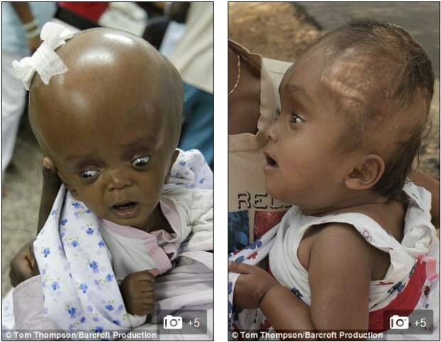 PoliFocus' Blog : Roona Begum: 3-Year-Old Girl Whose Head Was Bigger ...