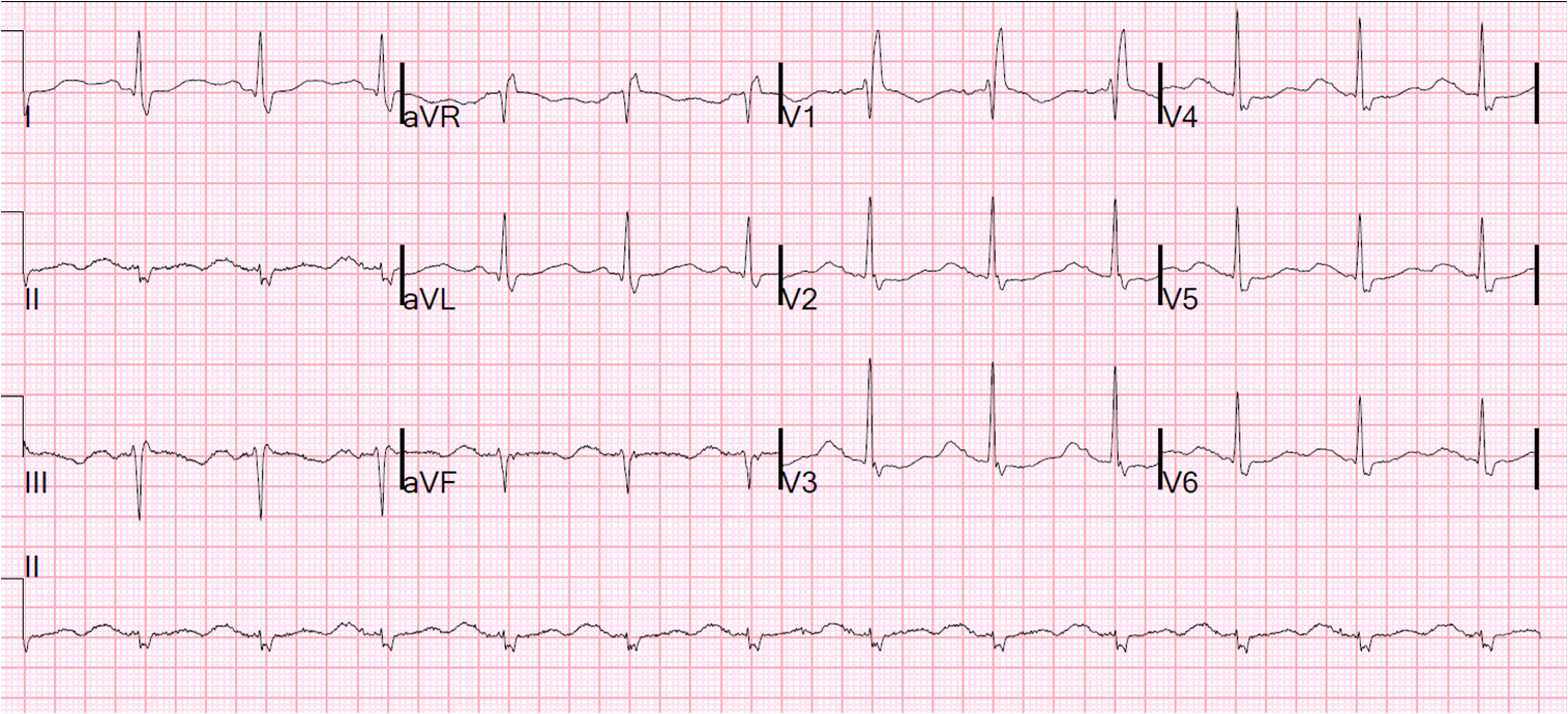 Dr. Smith's ECG Blog: Polymorphic Ventricular Tachycardia