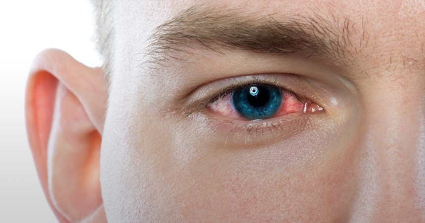 Solo para tus Ojos: Tengo una infección a los ojos..¿necesito antibióticos?