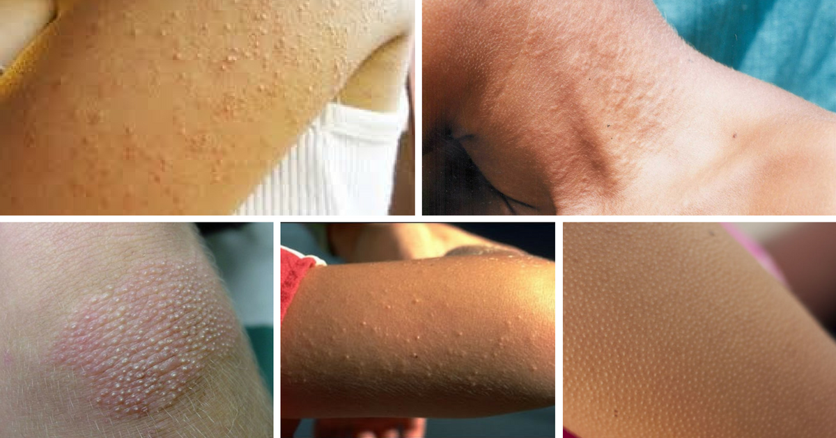 If you have these TINY BUMPS on your skin, READ THIS ASAP!