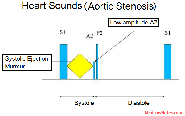 Aortic Stenosis Murmur