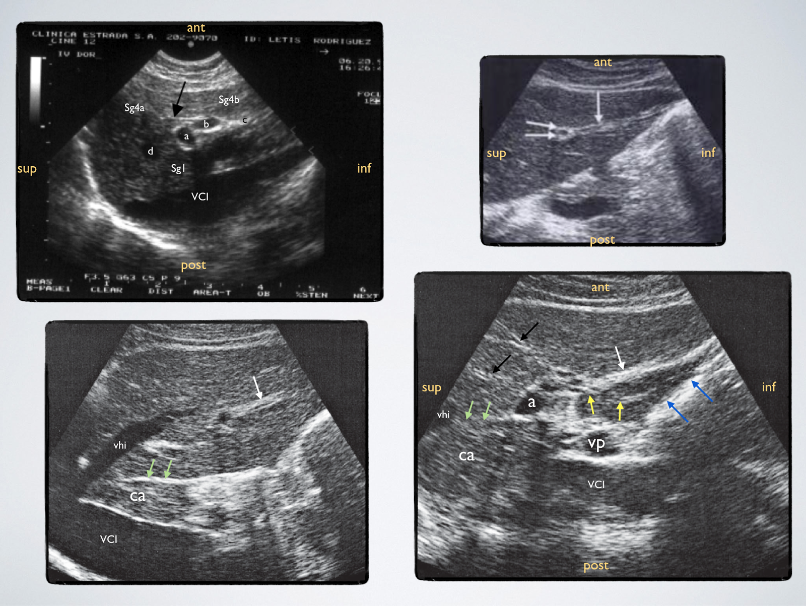 Cuadernos de Anatomía Quirúrgica: Segmentación hepática en ecografía.