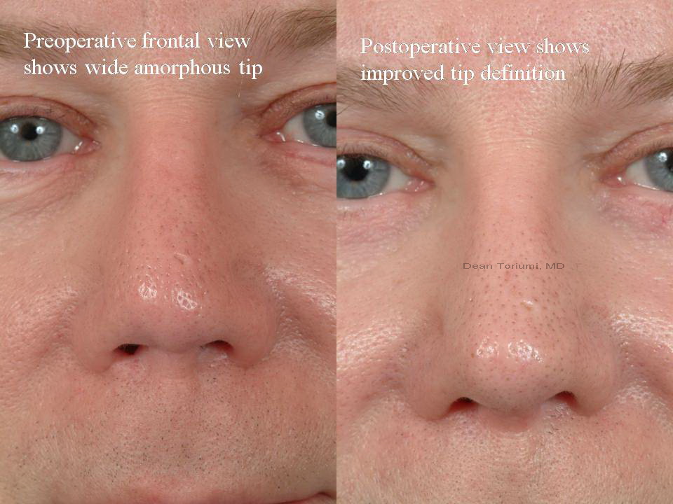 Dr. Dean Toriumi Reviews: Dean Toriumi Reviews: Severely scarred nose ...