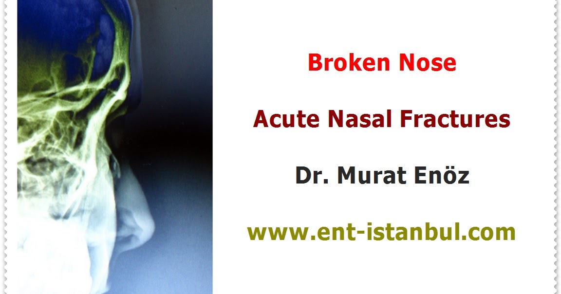 Nasal Fractures - Causes, Symptoms, Diagnosis, Treatment