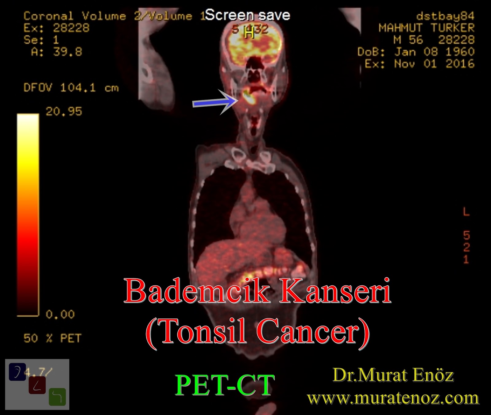 Tonsil Cancer - Causes, Symptoms, Diagnosis and Treatment