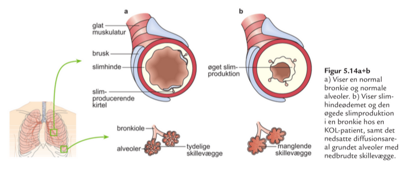 Genindlæggelse af patienter med KOL: KOL
