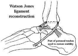 Me & My Ankle: 1/6/12 - Ankle School
