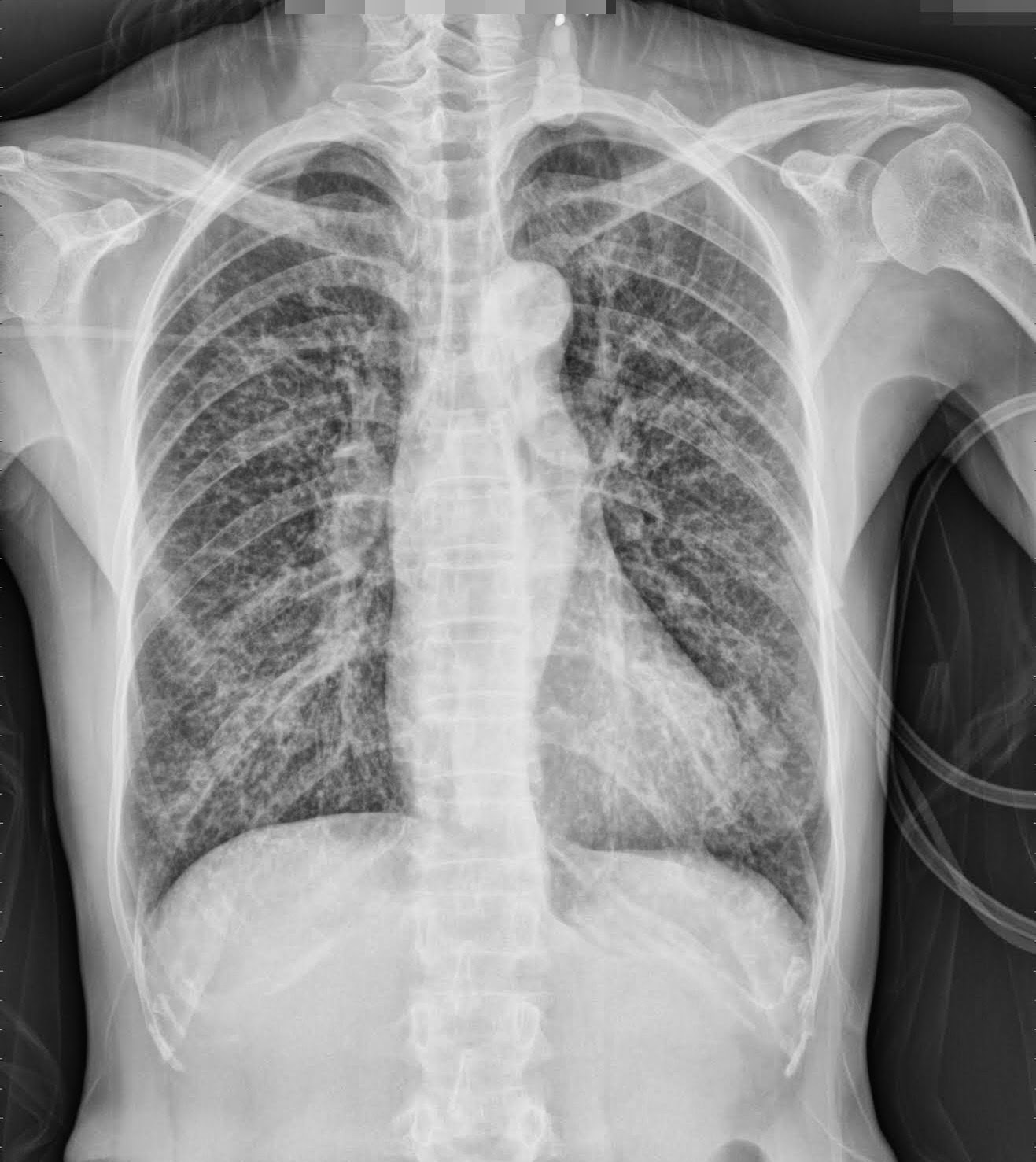 CXR 胸部x光判讀 Diffuse panbronchiolitis