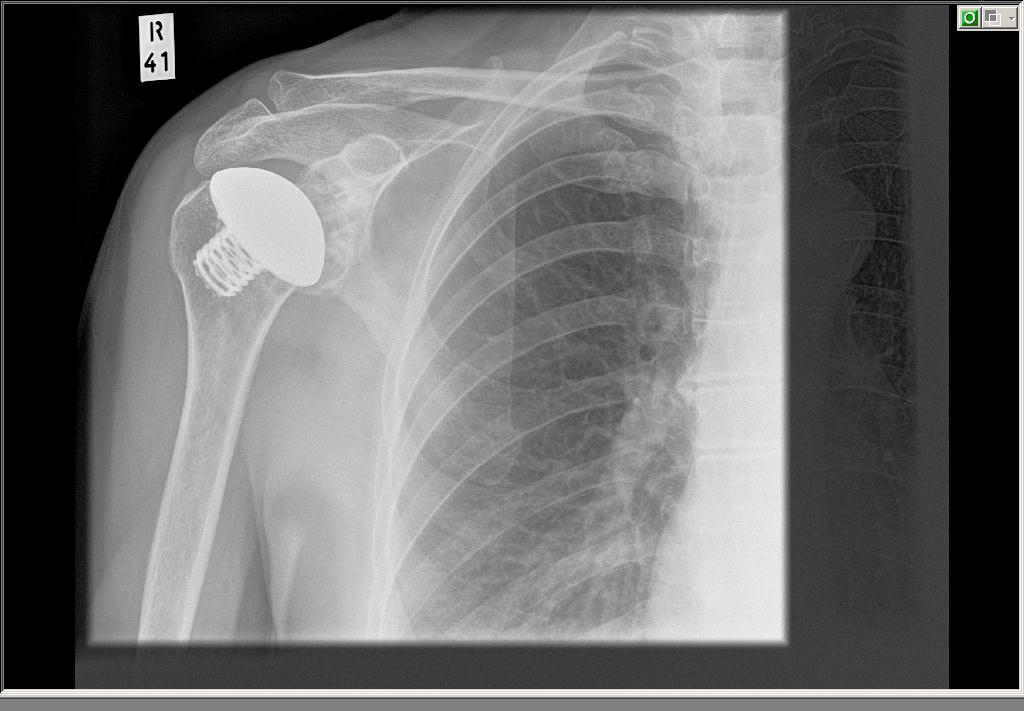 Indiaorthosurgeon: Shoulder Arthritis