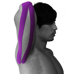 ARES Kinesiology Tape: Rheumatism of Elbow
