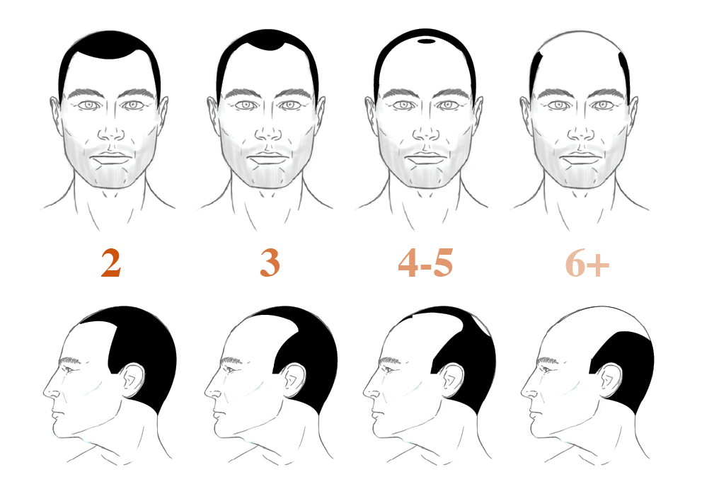 Female Pattern Baldness